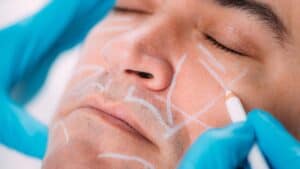 Dermal Needling With RF Perth | RF Microneedling | Luxe Medical Aesthetics